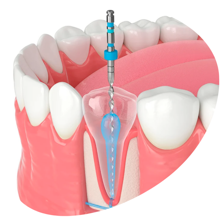 Endodoncia Juliaca - Puno - Clínica Dental | Felicium